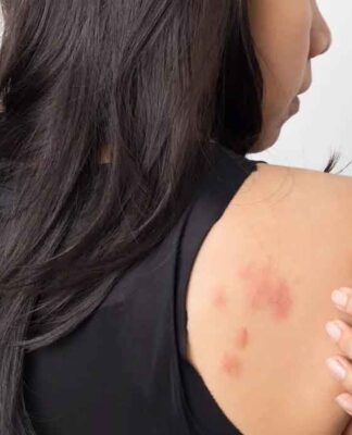 Blisters And Mould, Bacteria Exposure » Mycotox